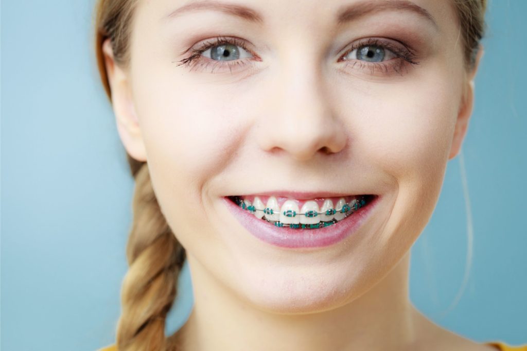 Clear Braces | McDermott Orthodontics | Family Orthodontist