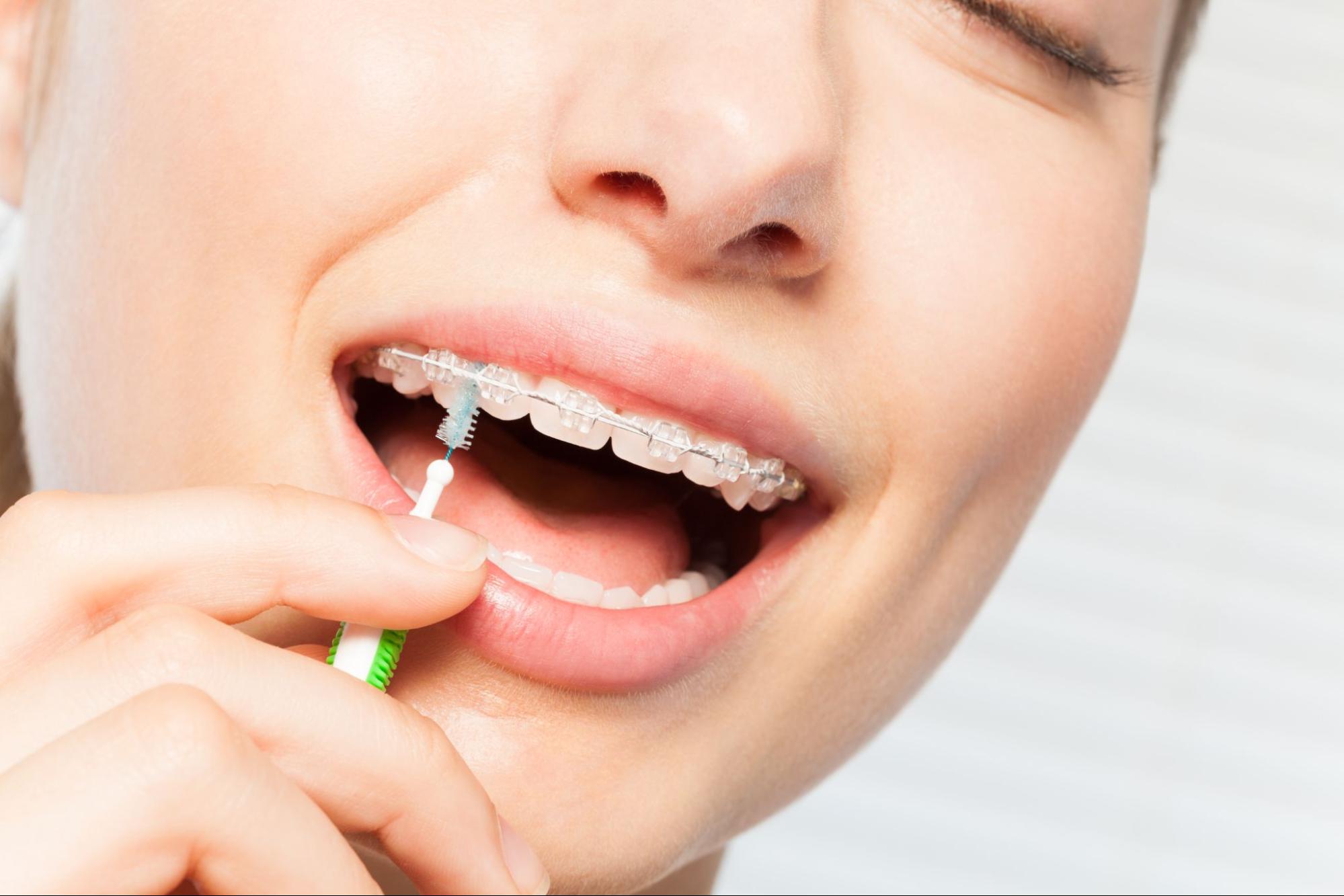 Tips for Keeping Your Braces Clean | McDermott Orthodontics